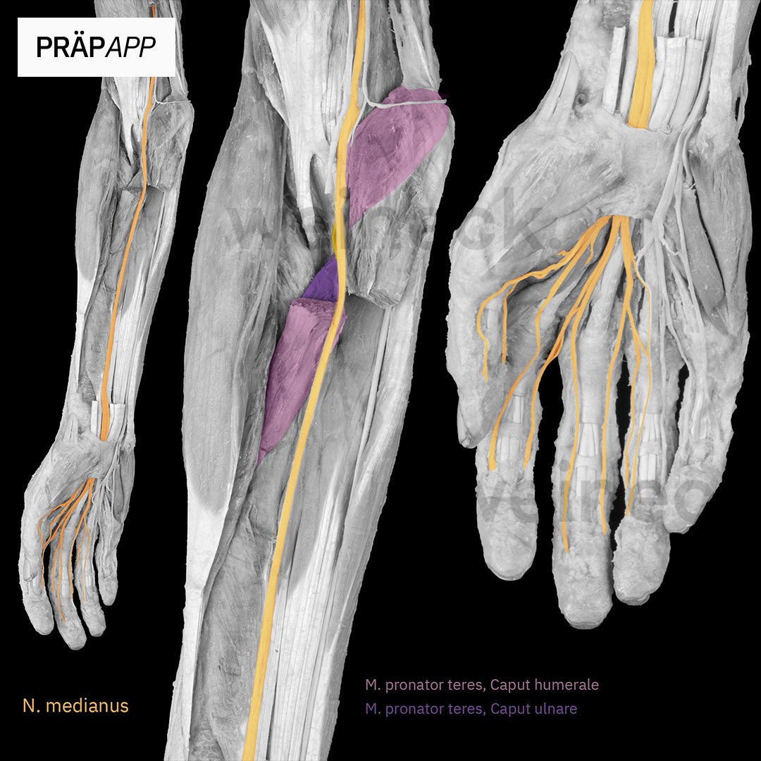IG: N. medianus – präpApp – Early Access